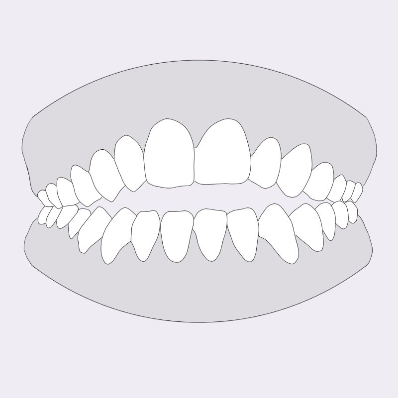 Zahnspangen für Kinder in Berlin | ZAHNSPANGE-MITTE - Kieferorthopädin ...